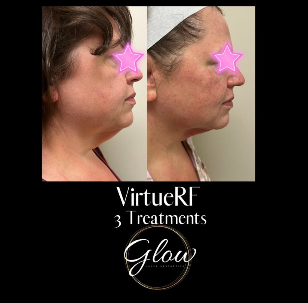 Before & After - Glow Laser Aesthetics